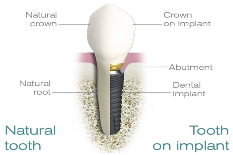 Everything you need to know about dental implants - LYRA ETK