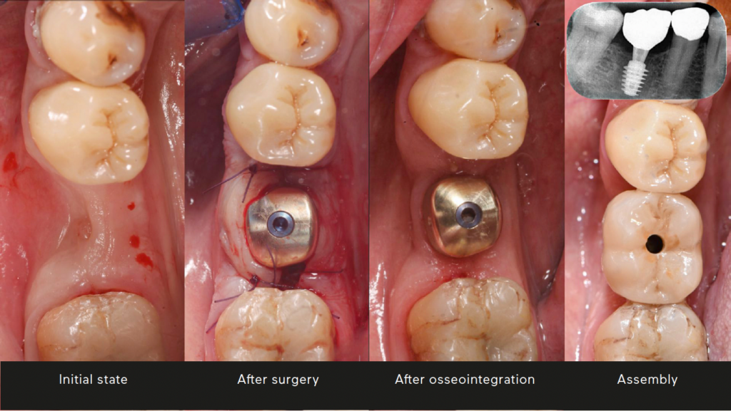 The benefits of iPhysio® healing abutments in managing the emergence ...
